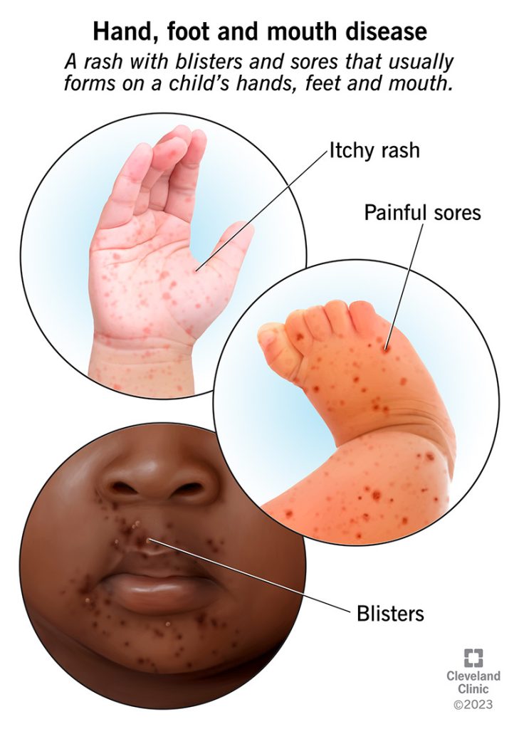Health officials confirm Hand, Foot, and Mouth Disease (HFMD) and ...
